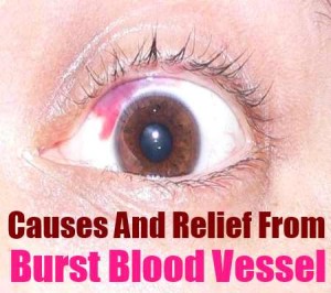 Various Causes And Quick Relief From Burst Blood Vessel | Natural Home ...